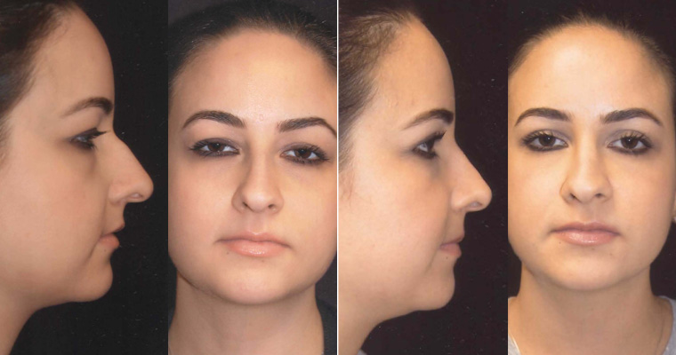 dr_ruder_0000s_0000_rhinoplasty-7 - Dr. Robert Ruder