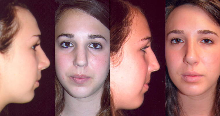 dr_ruder_0000s_0002_rhinoplasty-5 - Dr. Robert Ruder