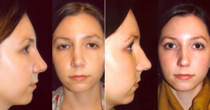 dr_ruder_0000s_0003_rhinoplasty-4 - Dr. Robert Ruder