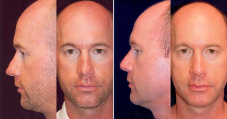 dr_ruder_0000s_0004_rhinoplasty-3 - Dr. Robert Ruder