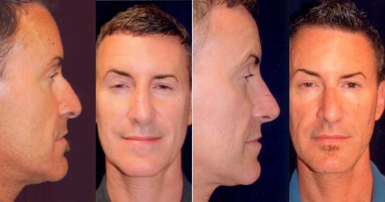 dr_ruder_0000s_0005_rhinoplasty-2 - Dr. Robert Ruder