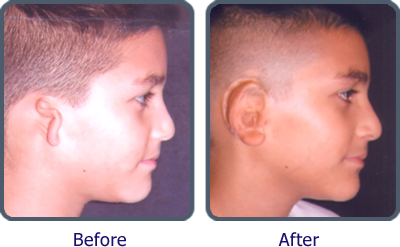 microtia1 - Dr. Robert Ruder