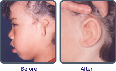 microtia2 - Dr. Robert Ruder
