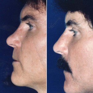 dr_ruder_Revision Rhinoplasty - Dr. Robert Ruder