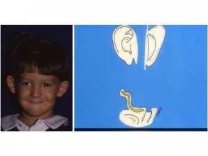 Conchal Excision and Suture Setback - Dr. Robert Ruder