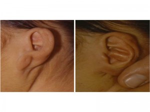 Ear Presentation - Dr. Robert Ruder