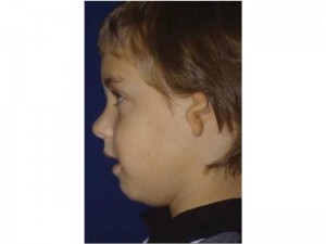 Common Abnormalities (Dysplastic ears) - Dr. Robert Ruder