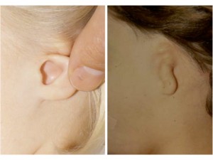 Ear Presentation - Dr. Robert Ruder