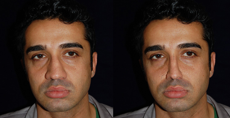 Dr. Robert Ruder - Plastic Surgery - Beverly Hills, California